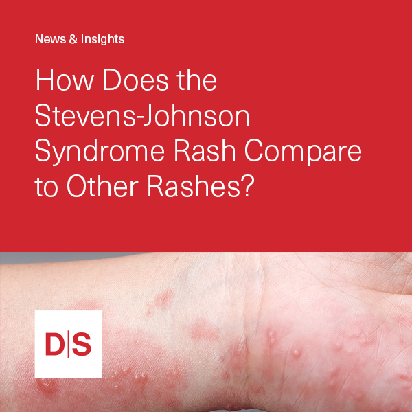 Stevens Johnson Syndrome Mild Rash